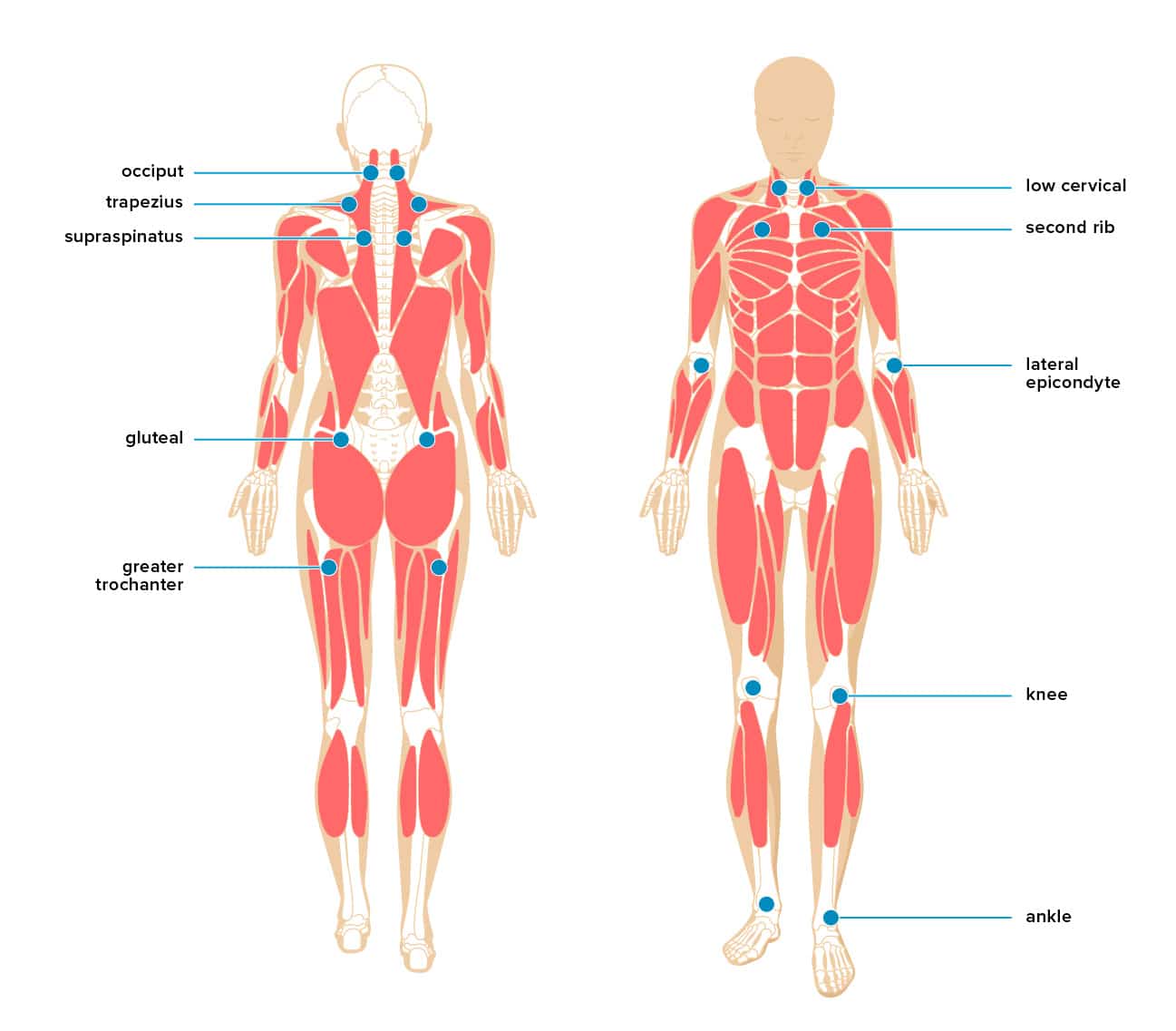 Myofascial Pain: How Trigger Point Injection Can Help